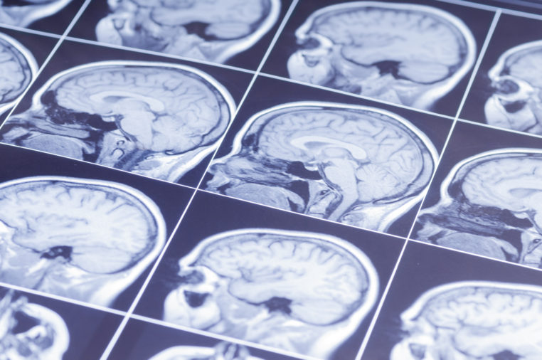 Defending the Mild Traumatic Brain Injury Case in California | Tyson ...